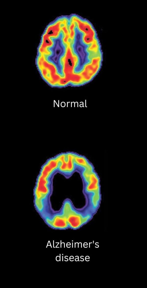 Concussion and Brain Recovery - Concussion Recovery Therapy